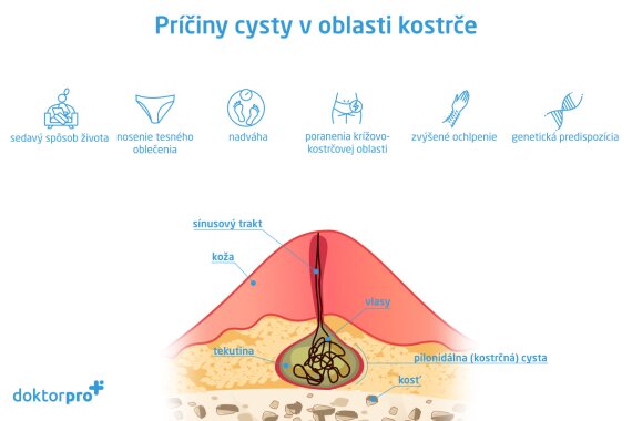 Príznaky pilonidálnej cysty (epitelový priechod kostrče) — blog ...