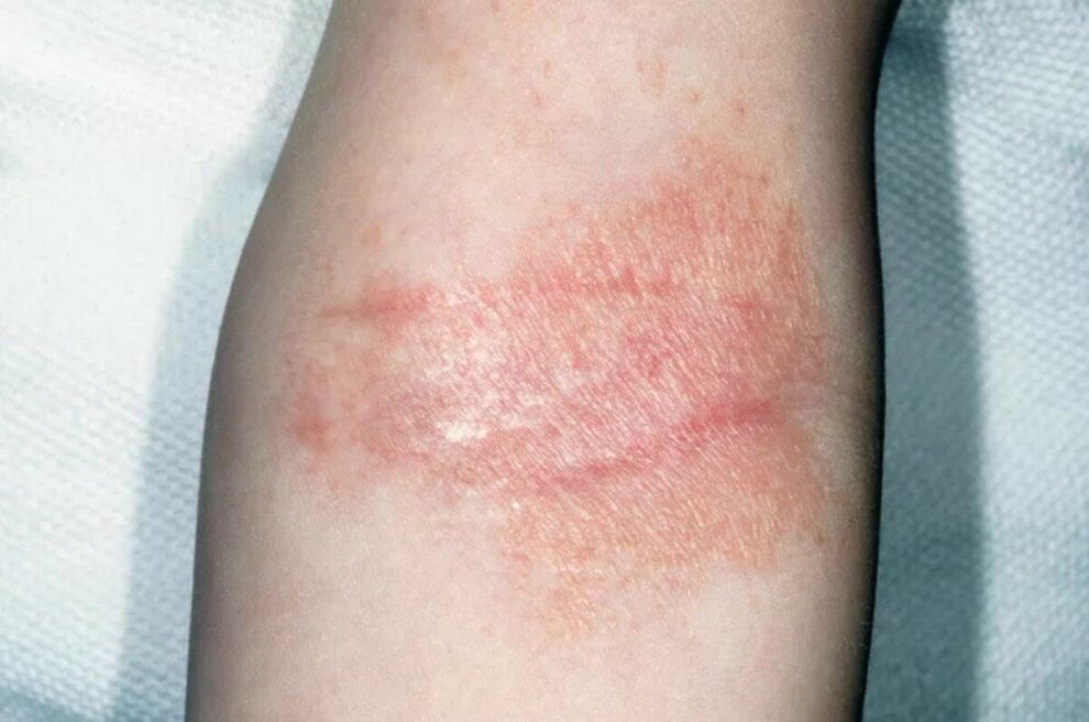 Príznaky neurodermatitídy a príčiny jej vzniku — blog medicínskeho ...