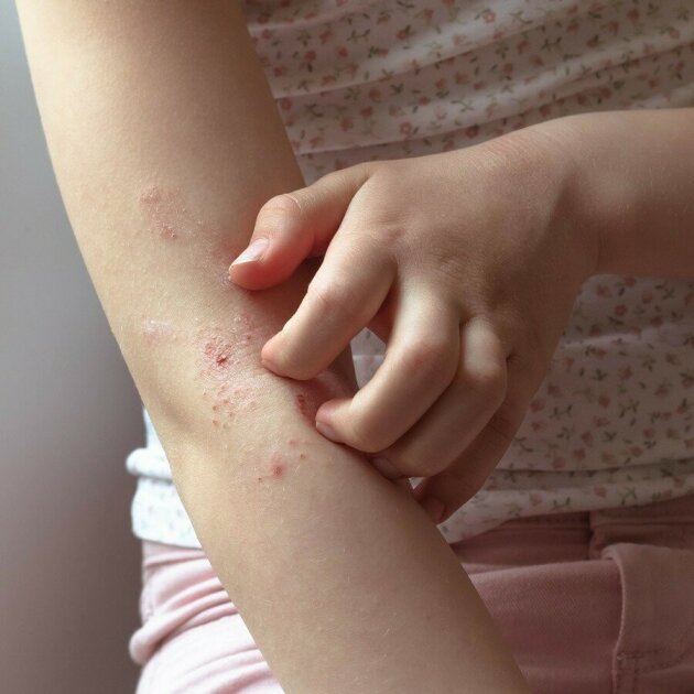 Príznaky neurodermatitídy a príčiny jej vzniku — blog medicínskeho ...