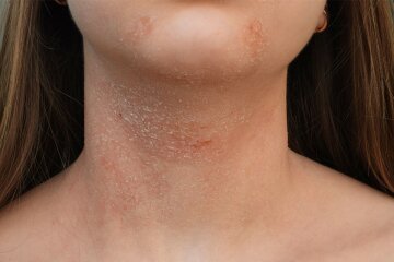 Príznaky atopickej dermatitídy a spôsob jej liečby — blog medicínskeho ...